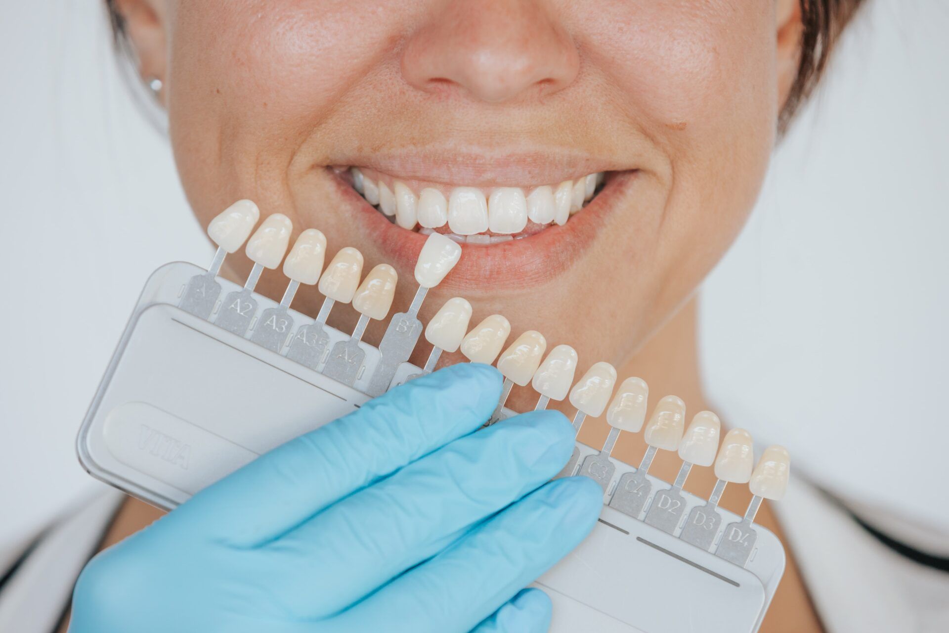 Zobu venīri | apinesklinika.lv